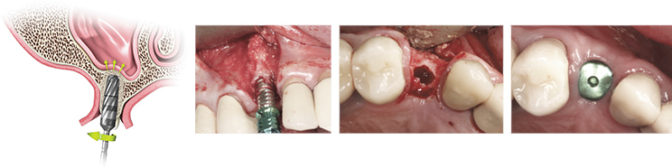 Osseodensification • ΙΝΣΤΙΤΟΥΤΟ ΜΕΡΙΜΝΑ